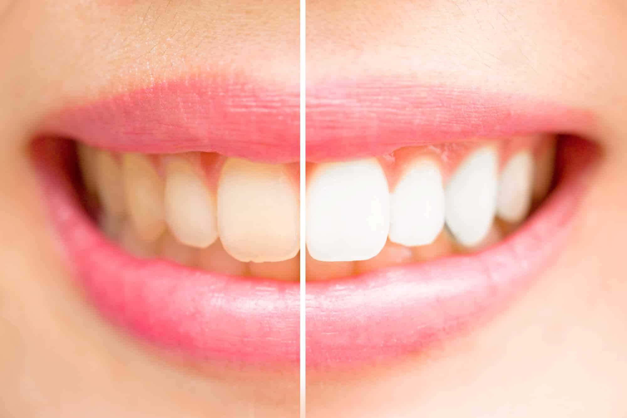 A Complete Guide on How to Whiten Teeth - Carolina Smiles